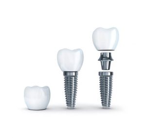 Implantes y cirugía oral | Trees